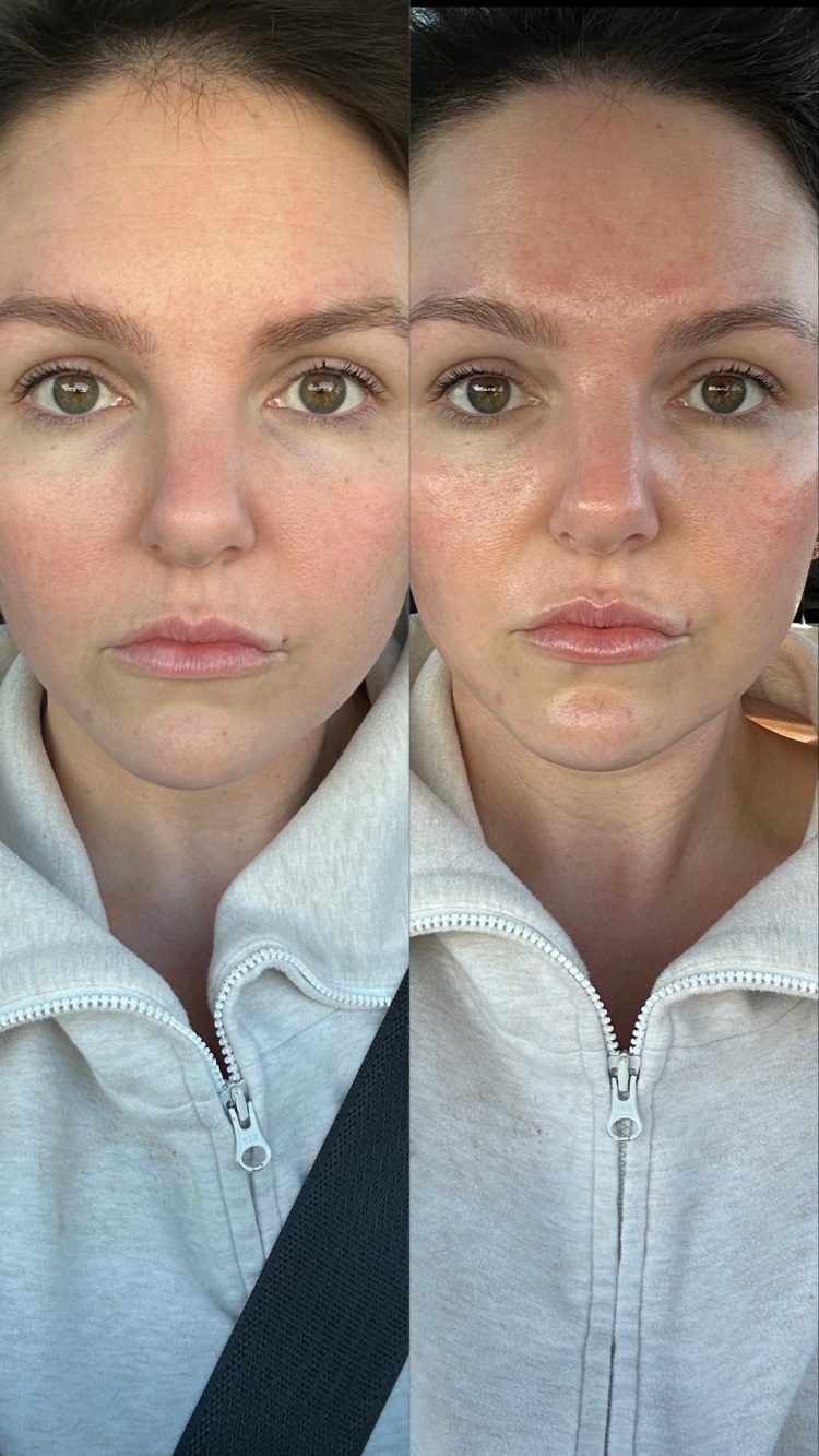 the-only-facial-before-after - Lovely Lucky Life